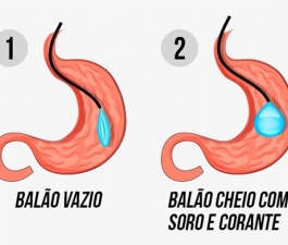 As 6 principais dúvidas sobre o balão intragástrico | Revista SuplementAção